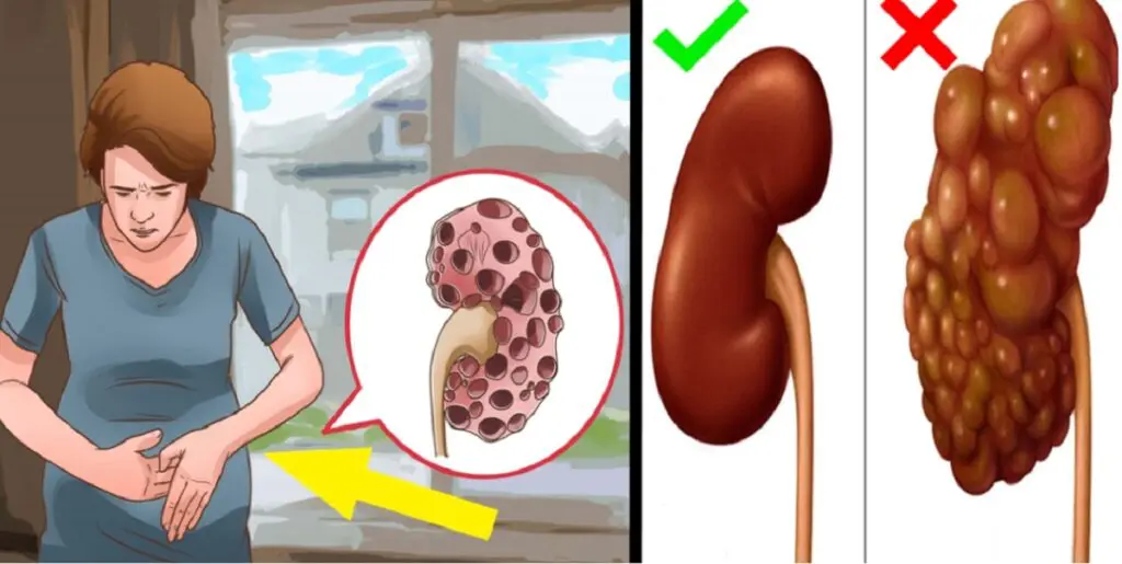 Sucul natural care curăță rinichii și tratează toate afecțiunile renale ...